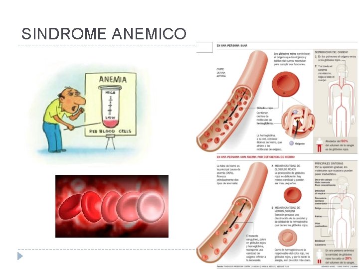 CLNICA HEMATOLOGA SINDROME ANEMICO SNDROME ANMICO ANEMIA vs