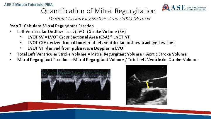 Quantification of Mitral Regurgitation Proximal Isovelocity Surface Area