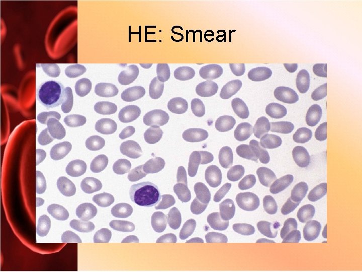 MLO 130 Hematology I Membrane Defects Introduction Hemolytic