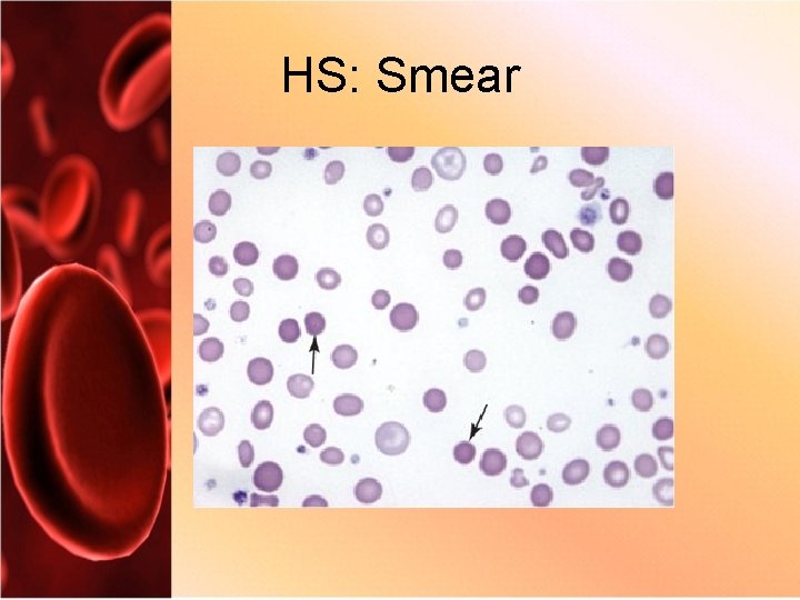 MLO 130 Hematology I Membrane Defects Introduction Hemolytic