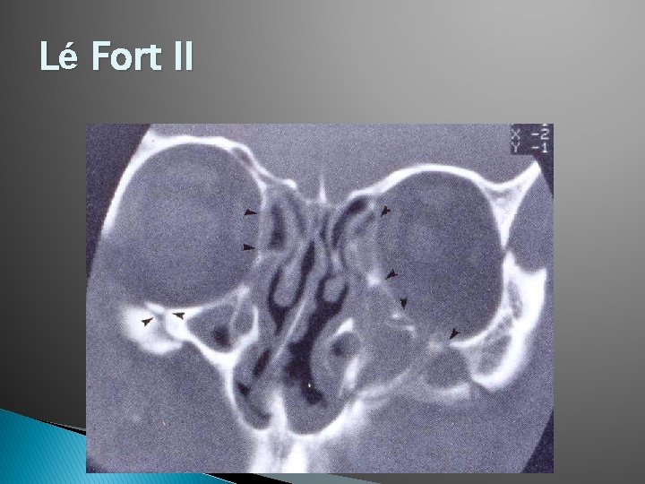 MAXILLARY FRACTURES Midface Fractures LEFORT AP VIEW Le