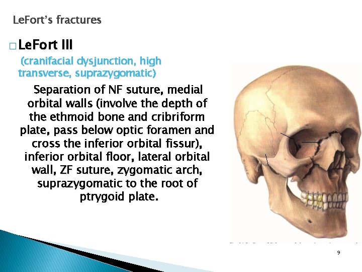 MAXILLARY FRACTURES Midface Fractures LEFORT AP VIEW Le