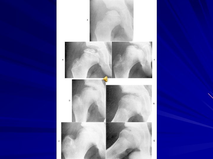 PERTHES DISEASE LeggCalvePerthes Disease Coxa Plana PROFESSORAYMAN SOLIMAN