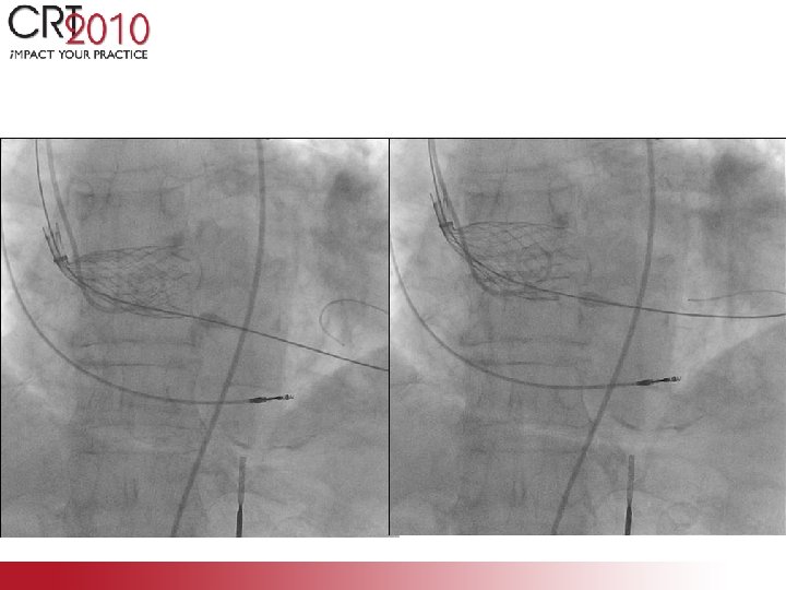 The SelfExpanding Medtronic Core Valve Transcatheter Valve System