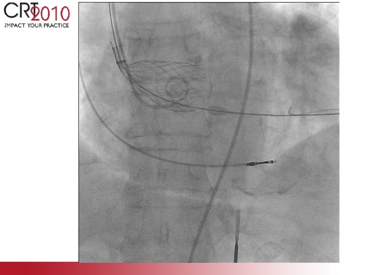 The SelfExpanding Medtronic Core Valve Transcatheter Valve System