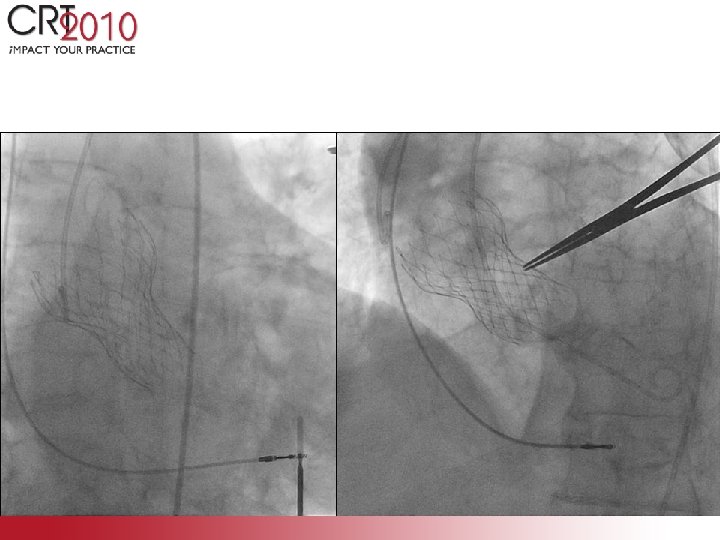 The SelfExpanding Medtronic Core Valve Transcatheter Valve System