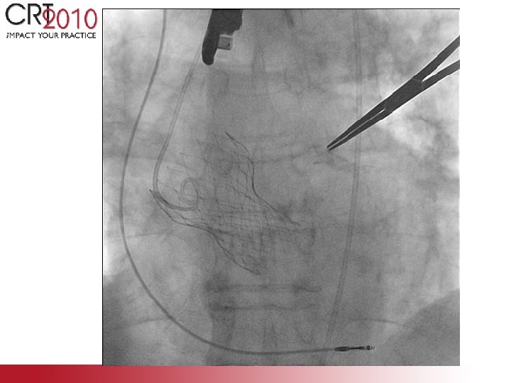 The SelfExpanding Medtronic Core Valve Transcatheter Valve System