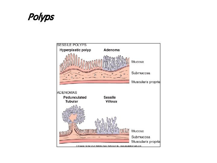 GNB Pathology 2019 Benign Tumors of Intestine Dr