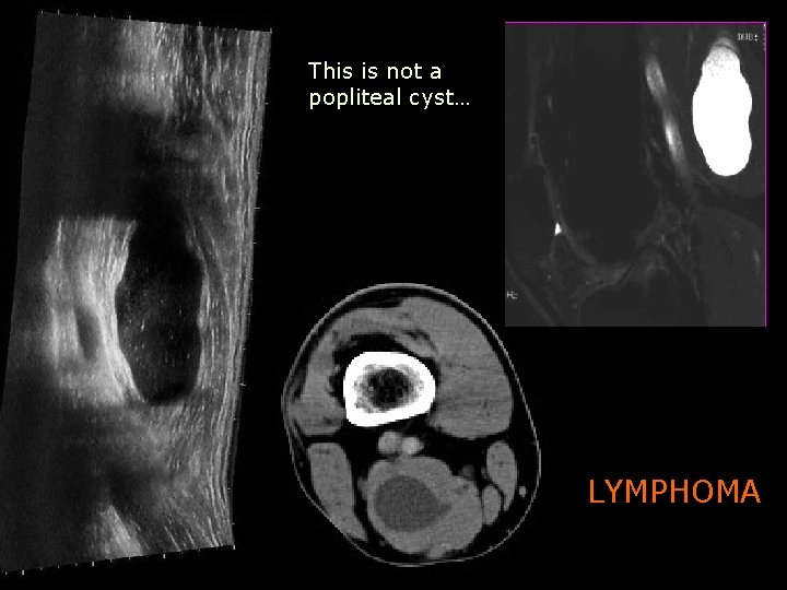 SOFT TISSUE TUMORS Early diagnosis Nicolas SANS Hpital