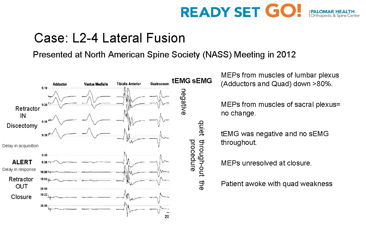 Intraoperative Neuromonitoring IONM During Orthopedic Spine Procedures W