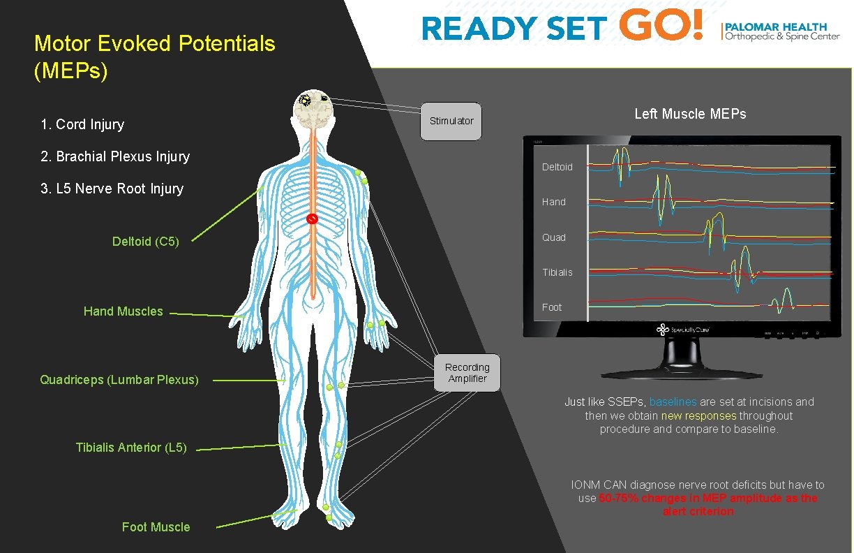Intraoperative Neuromonitoring IONM During Orthopedic Spine Procedures W