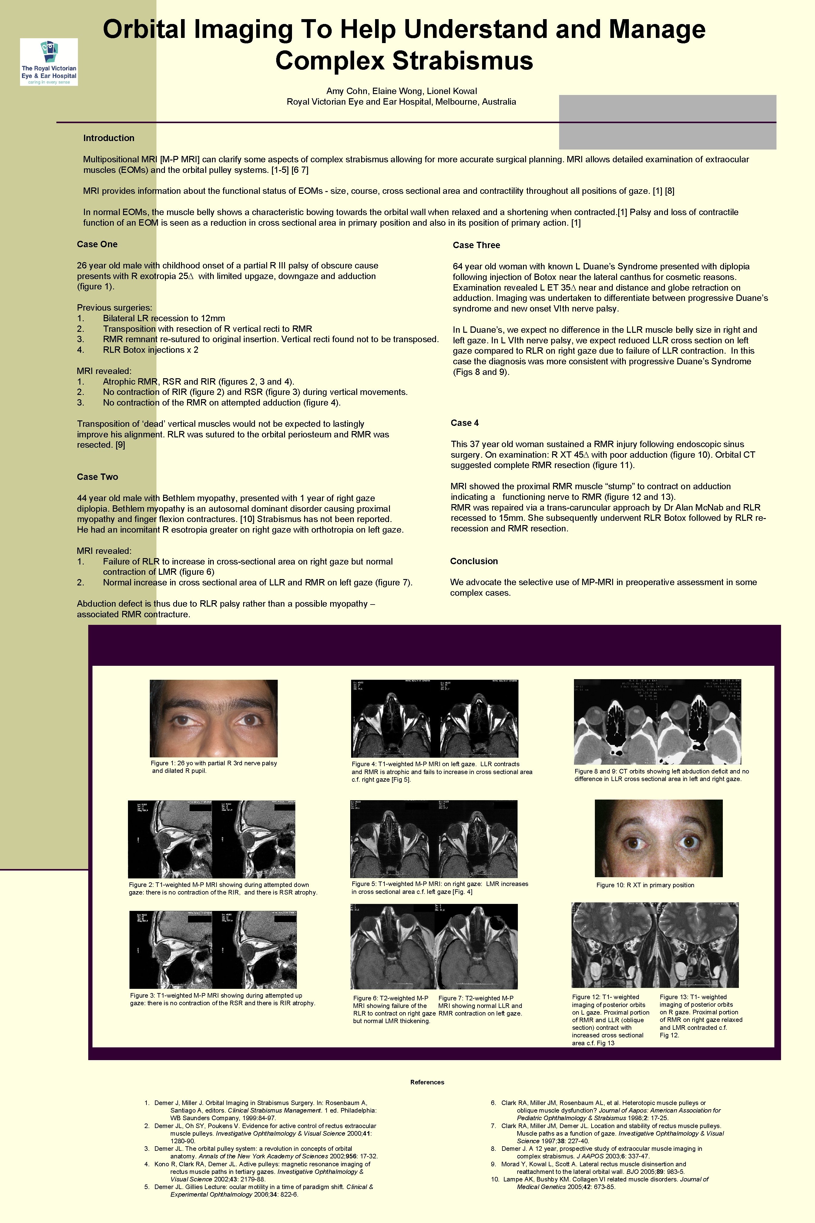 Orbital Imaging To Help Understand Manage Complex Strabismus