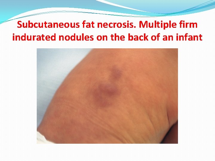 Common neonatal skin disorders massive Candidosis Diaper Rash