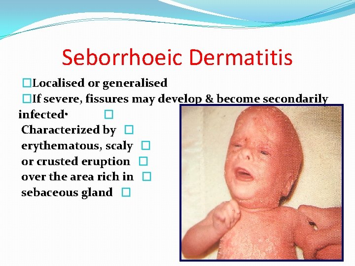 Common neonatal skin disorders massive Candidosis Diaper Rash