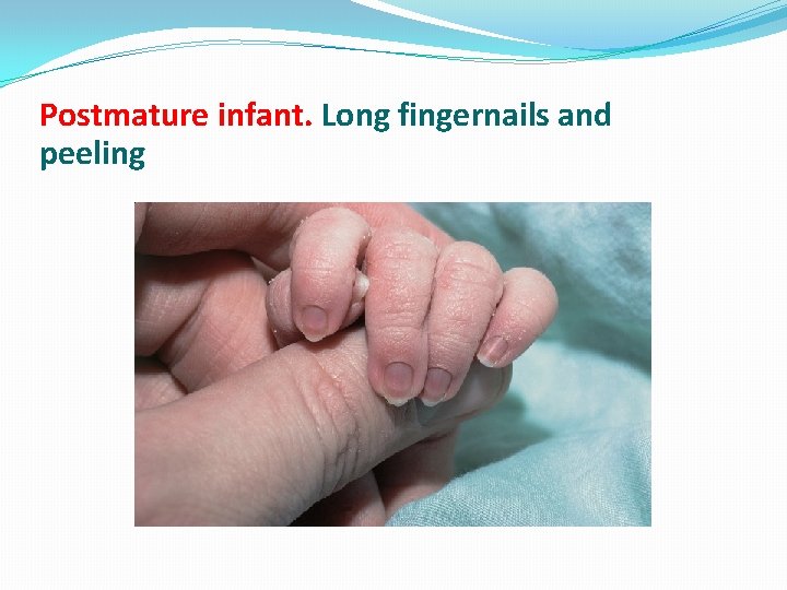 Common neonatal skin disorders massive Candidosis Diaper Rash