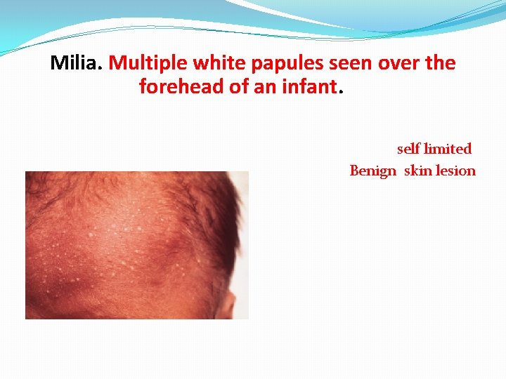 Common neonatal skin disorders massive Candidosis Diaper Rash