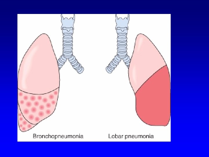 Pulmonary infections Pneumonia Pneumonia can be very broadly