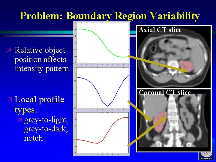 Clustering on Image Boundary Regions for Deformable Model