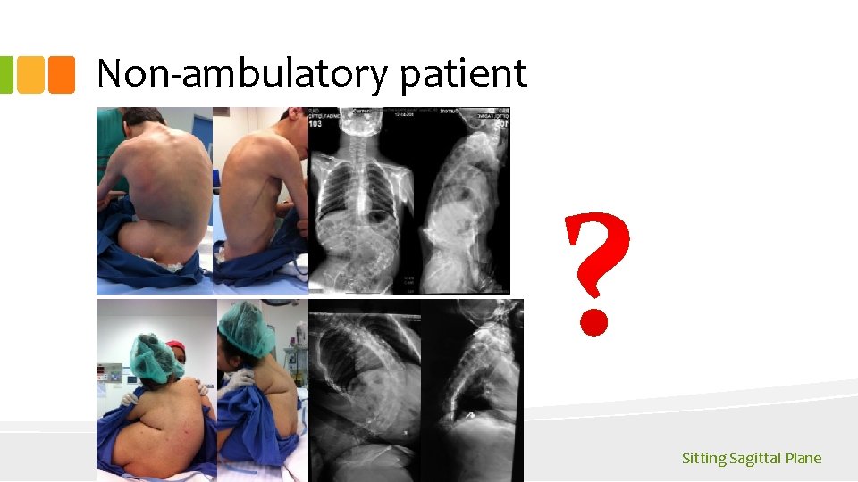 Sagittal alignment of the spine is changing Evolution