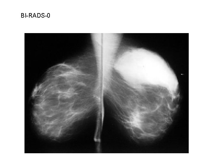 BIRADS BIRADS BIRADS CLASIFICACION BIRADS v Breast Imaging