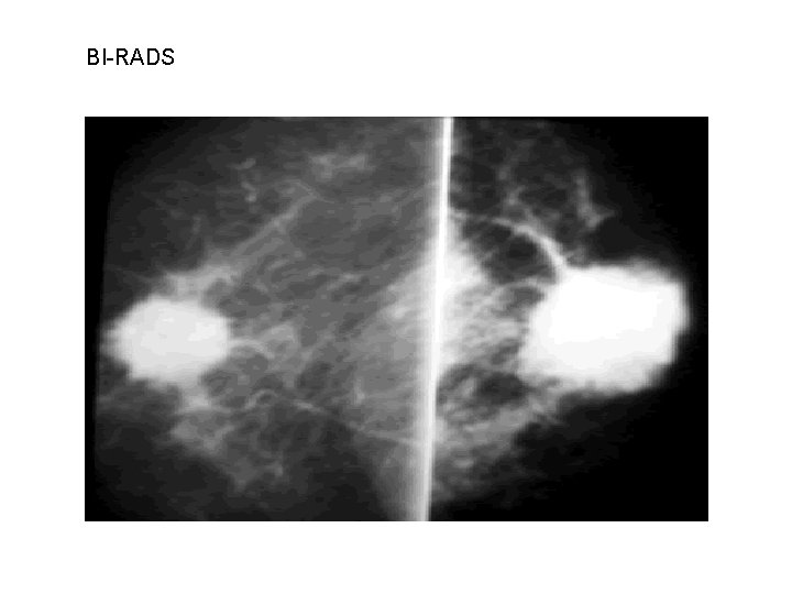 BIRADS BIRADS BIRADS CLASIFICACION BIRADS v Breast Imaging