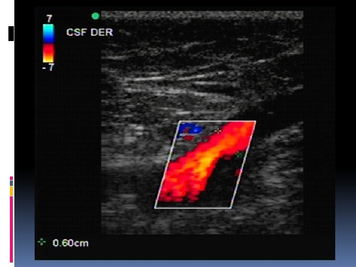 Ecografa Doppler En La Insuficiencia Venosa De Miembros