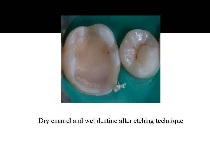 Resin Cements Cementation of Aesthetic Resin Composite Indirect