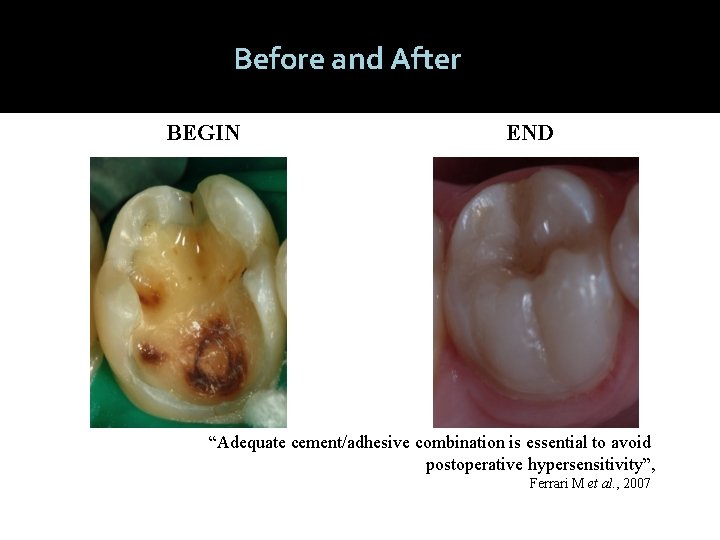 Resin Cements Cementation of Aesthetic Resin Composite Indirect
