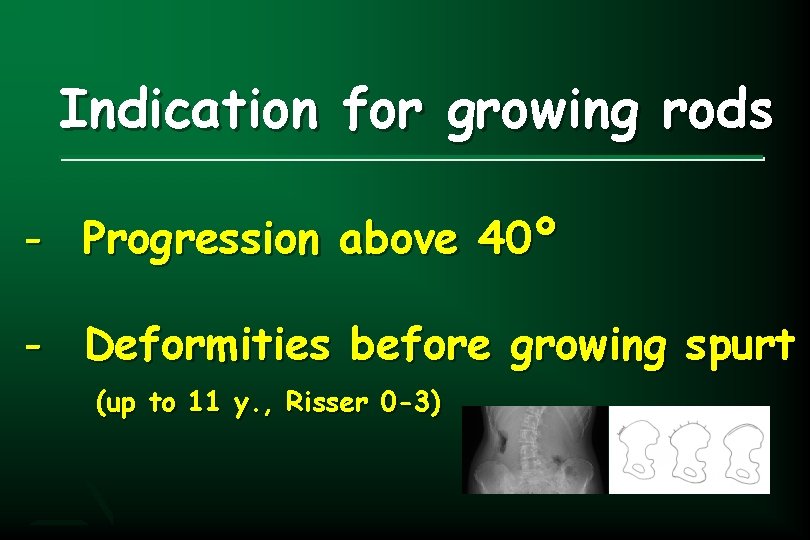 Growing rods in severe juvenile neuromuscular scoliosis M