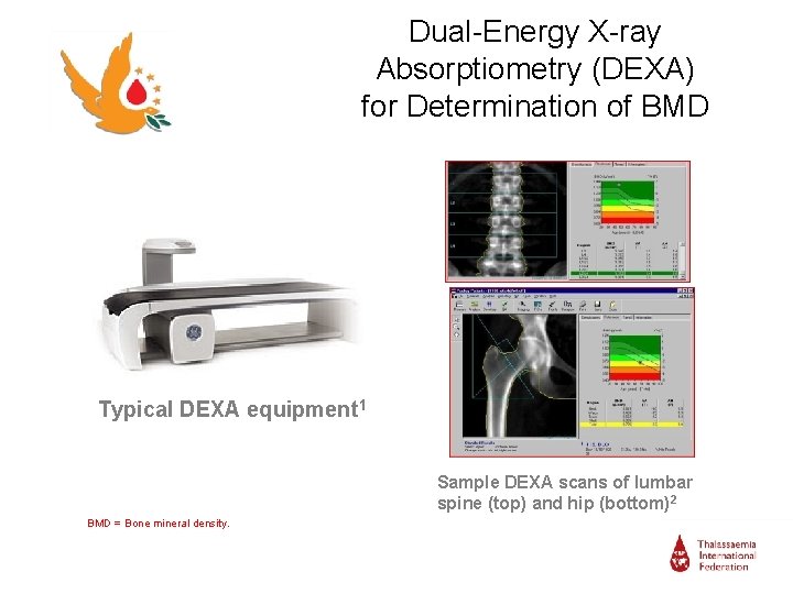 Bone Disease in haemoglobin disorders Ersi Voskaridou 1