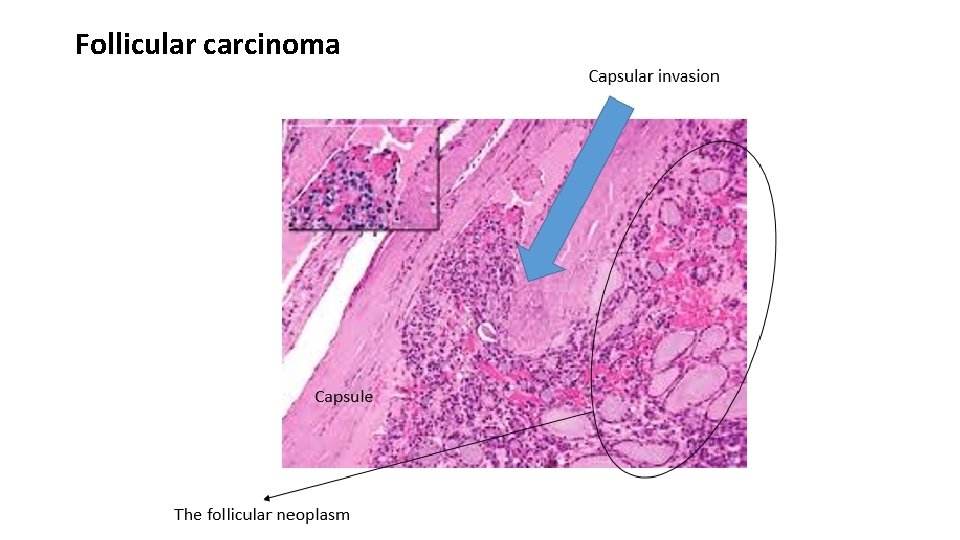 Atrophy of thyroid Hashimoto thyroiditis Hashimoto is more