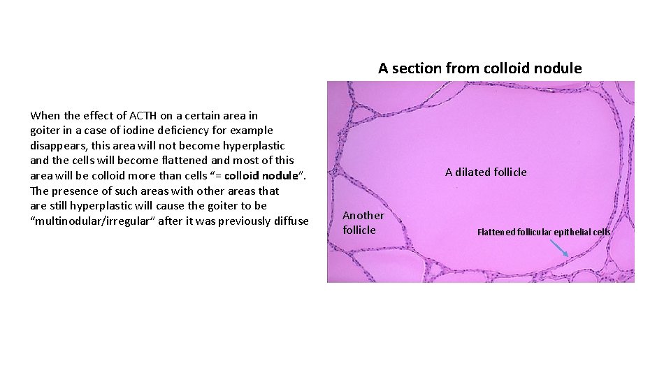 Atrophy of thyroid Hashimoto thyroiditis Hashimoto is more