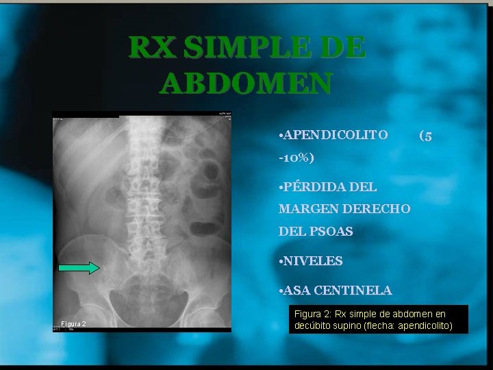 APENDICITIS ANATOMA APNDICE Estructura tubular en fondo de