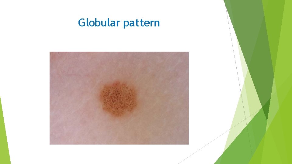 Dermoscopy Presented By Dr H Mozayyeni Dermoscopy may