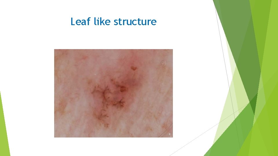 Dermoscopy Presented By Dr H Mozayyeni Dermoscopy may