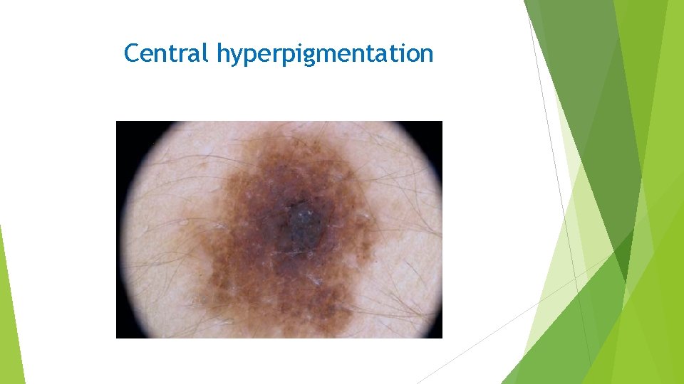 Dermoscopy Presented By Dr H Mozayyeni Dermoscopy may