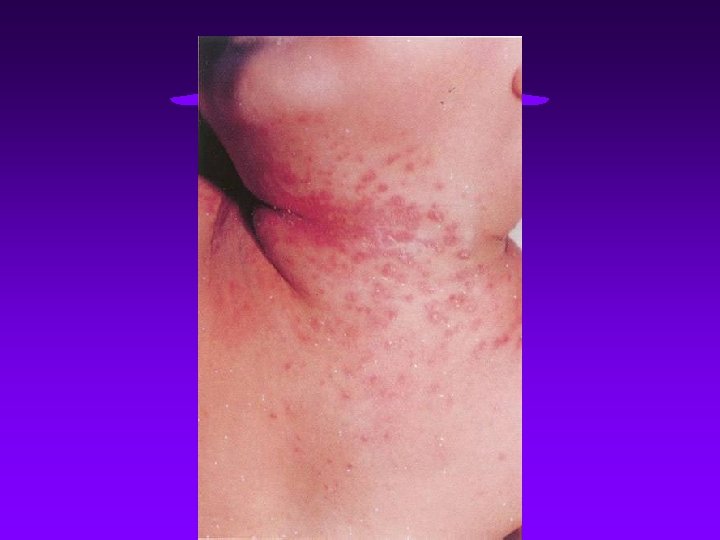 candidiasis Defination candida albican may cause different types