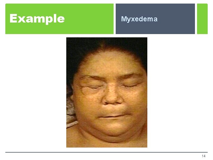 Hypothyroidism By Michelle Russell 1 Objectives o To