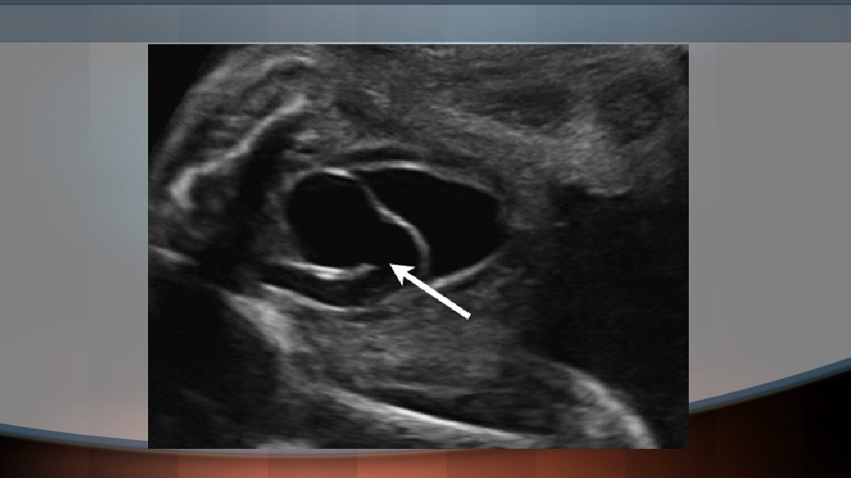 PRENATAL ULTRASOUNDGRAPHIC FEATURES OF DIFFERENT CONGENITAL ...
