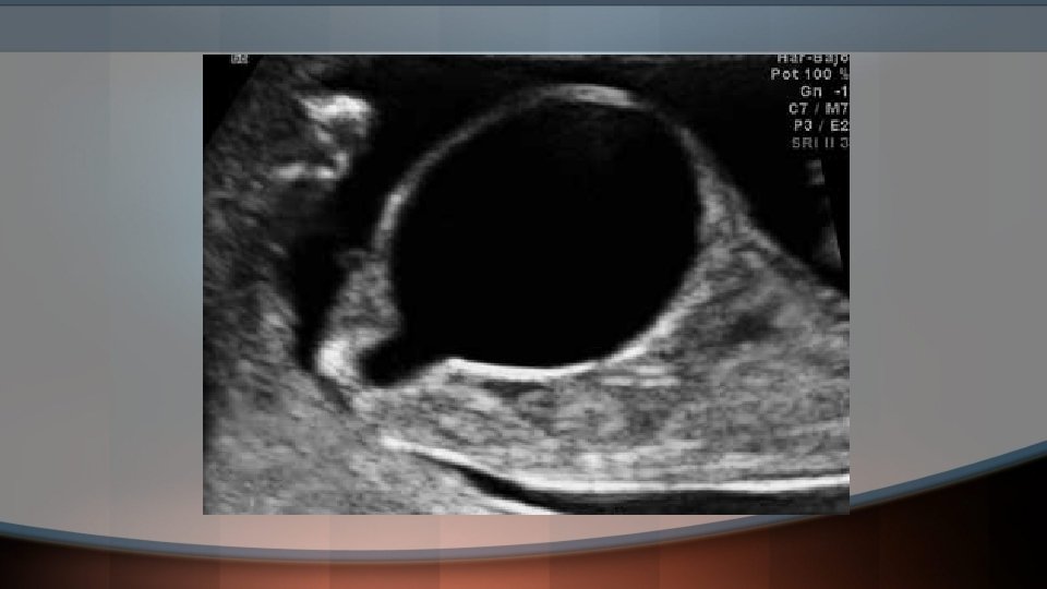PRENATAL ULTRASOUNDGRAPHIC FEATURES OF DIFFERENT CONGENITAL ...