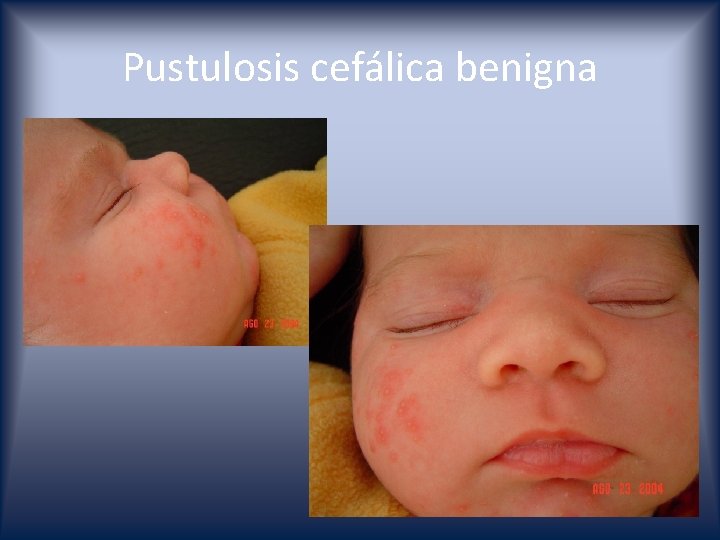 DERMATOSIS NEONATALES Dra Susana Habermacher CATEDRA DE DERMATOLOGIA