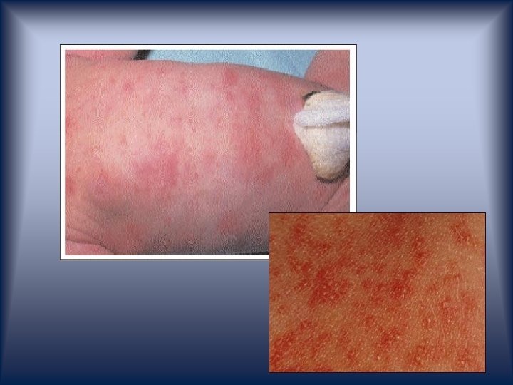 DERMATOSIS NEONATALES Dra Susana Habermacher CATEDRA DE DERMATOLOGIA