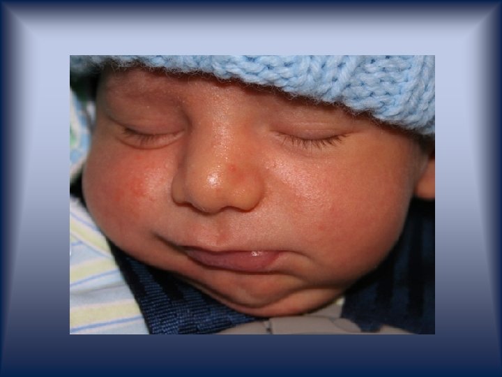 DERMATOSIS NEONATALES Dra Susana Habermacher CATEDRA DE DERMATOLOGIA