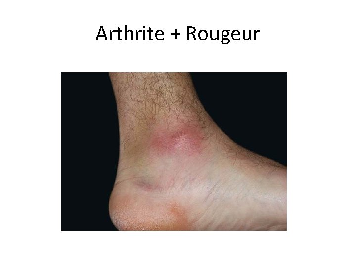 ARTHRITES REACTIONNELLES DR A ABIAYAD RhumatologieHCA DEFINITION Maladie