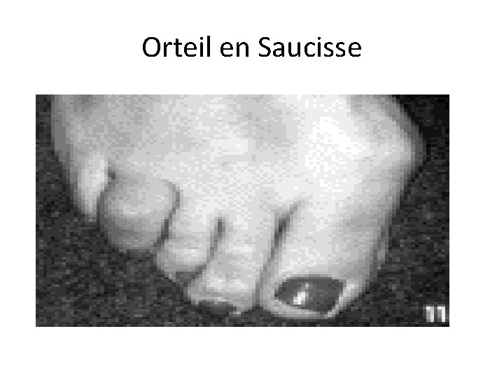 ARTHRITES REACTIONNELLES DR A ABIAYAD RhumatologieHCA DEFINITION Maladie