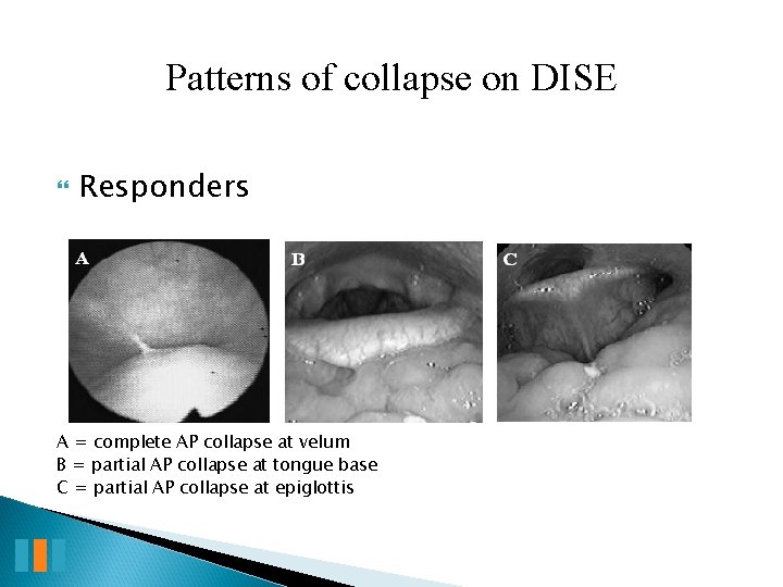 Logistics and Relevance of Drug Induced Sleep Endoscopy