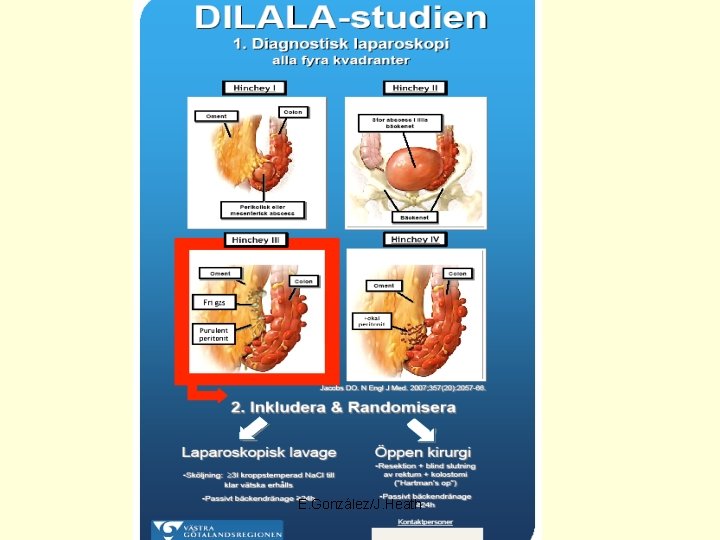 DILALA Diverticulitis laparoscopic lavage vs resection Hartman procedure