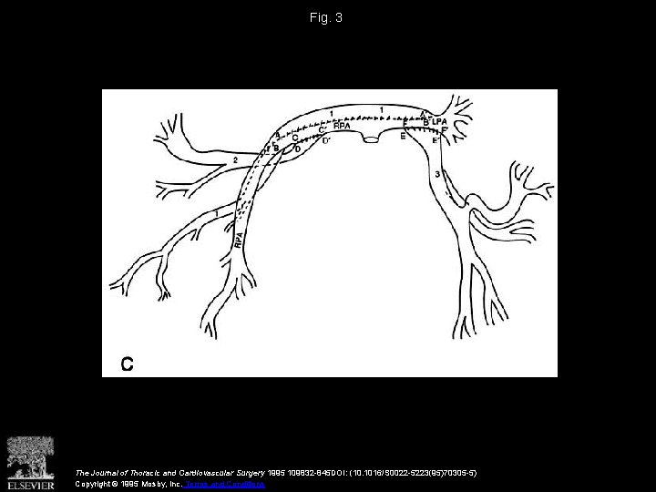 Midline onestage complete unifocalization and repair of pulmonary