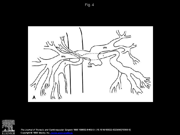Midline onestage complete unifocalization and repair of pulmonary