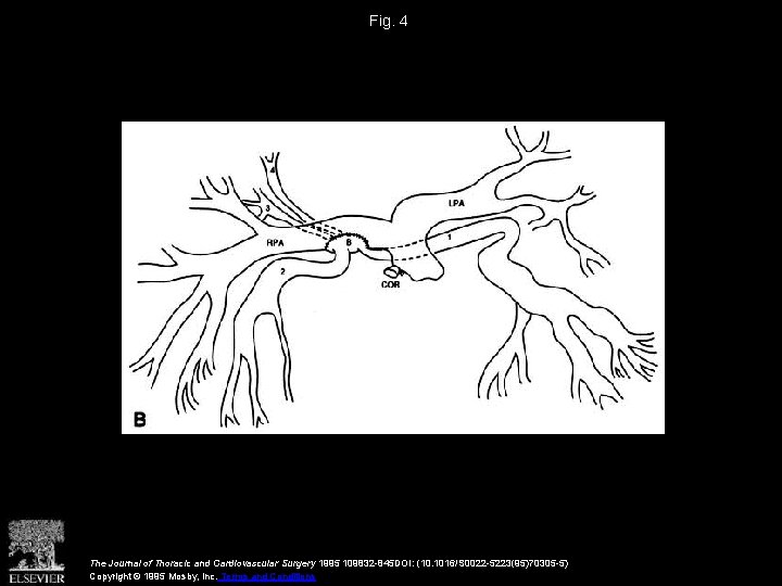 Midline onestage complete unifocalization and repair of pulmonary